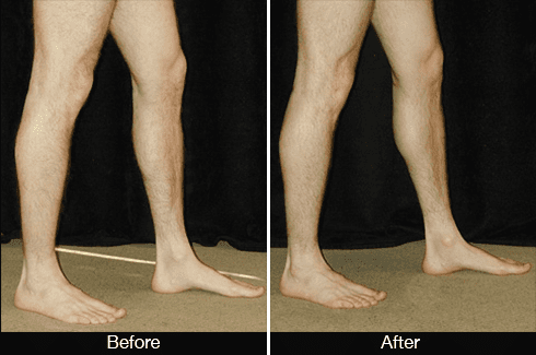 Calf Implants Surgery in Newport Beach | T.Y. Steven Ip, M.D., F.A.C.S.