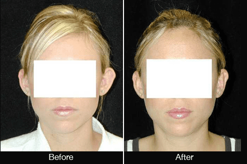 Ear Surgery (Otoplasty) in Newport Beach | T.Y. Steven Ip, M.D., F.A.C.S.